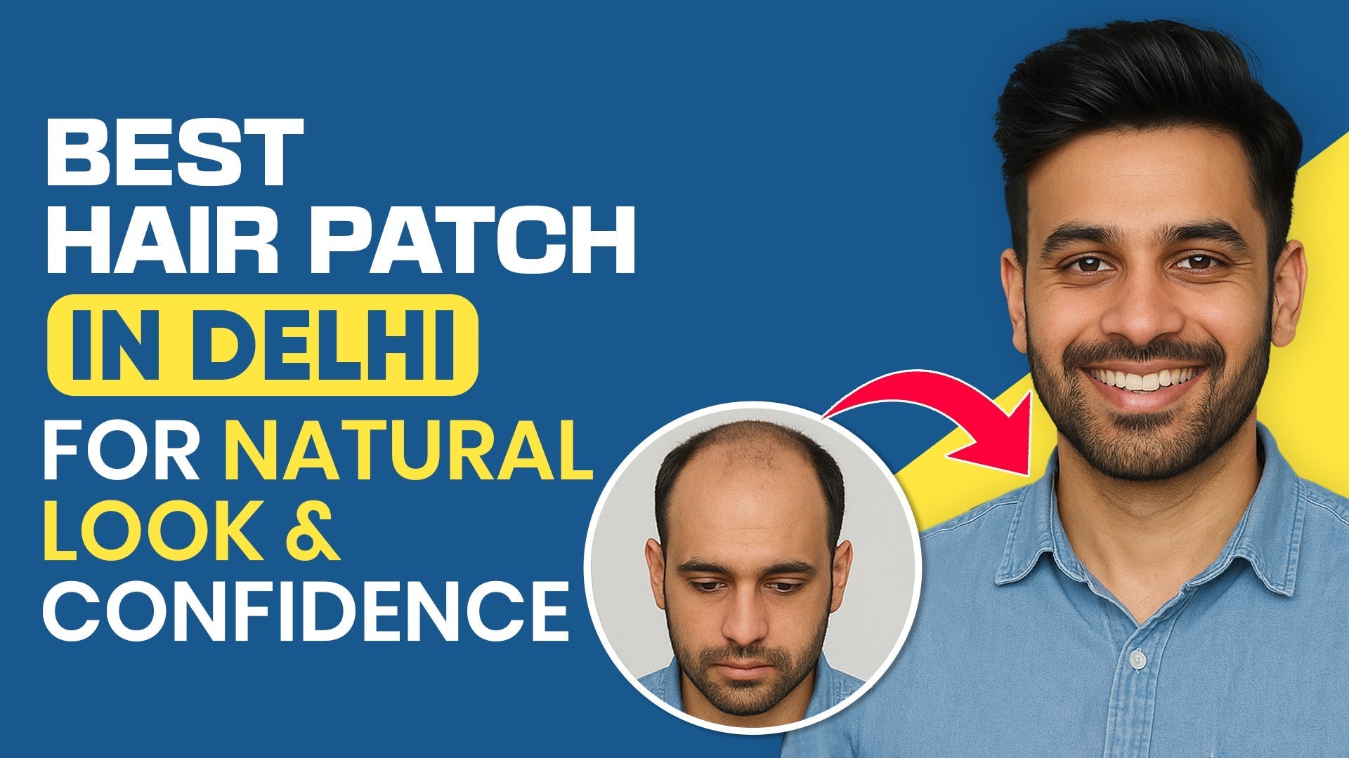 Best Hair Patch in Delhi for Natural Look & Confidence – Malhotra Hair ...